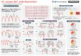 VT vs. SVT with Abberation Infographic – Visualmed: Clinical Trials