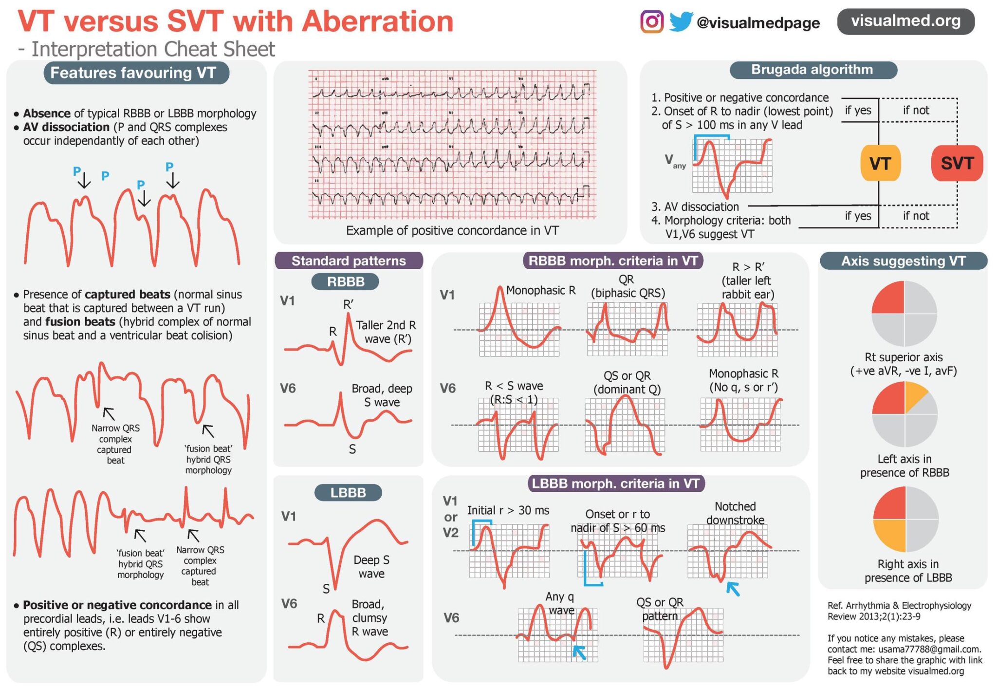 VT vs. SVT with Abberation Infographic - Visualmed: Clinical Trials