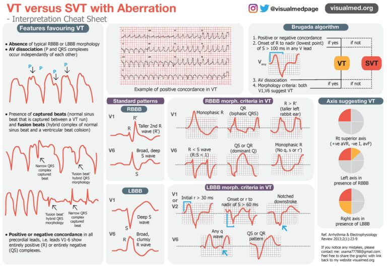 VT vs. SVT with Abberation Infographic – Visualmed: Clinical Trials